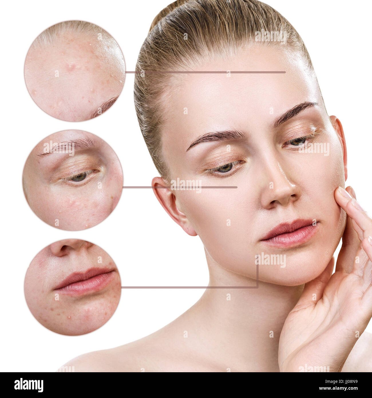 Circles shows problem skin of young woman Stock Photo - Alamy