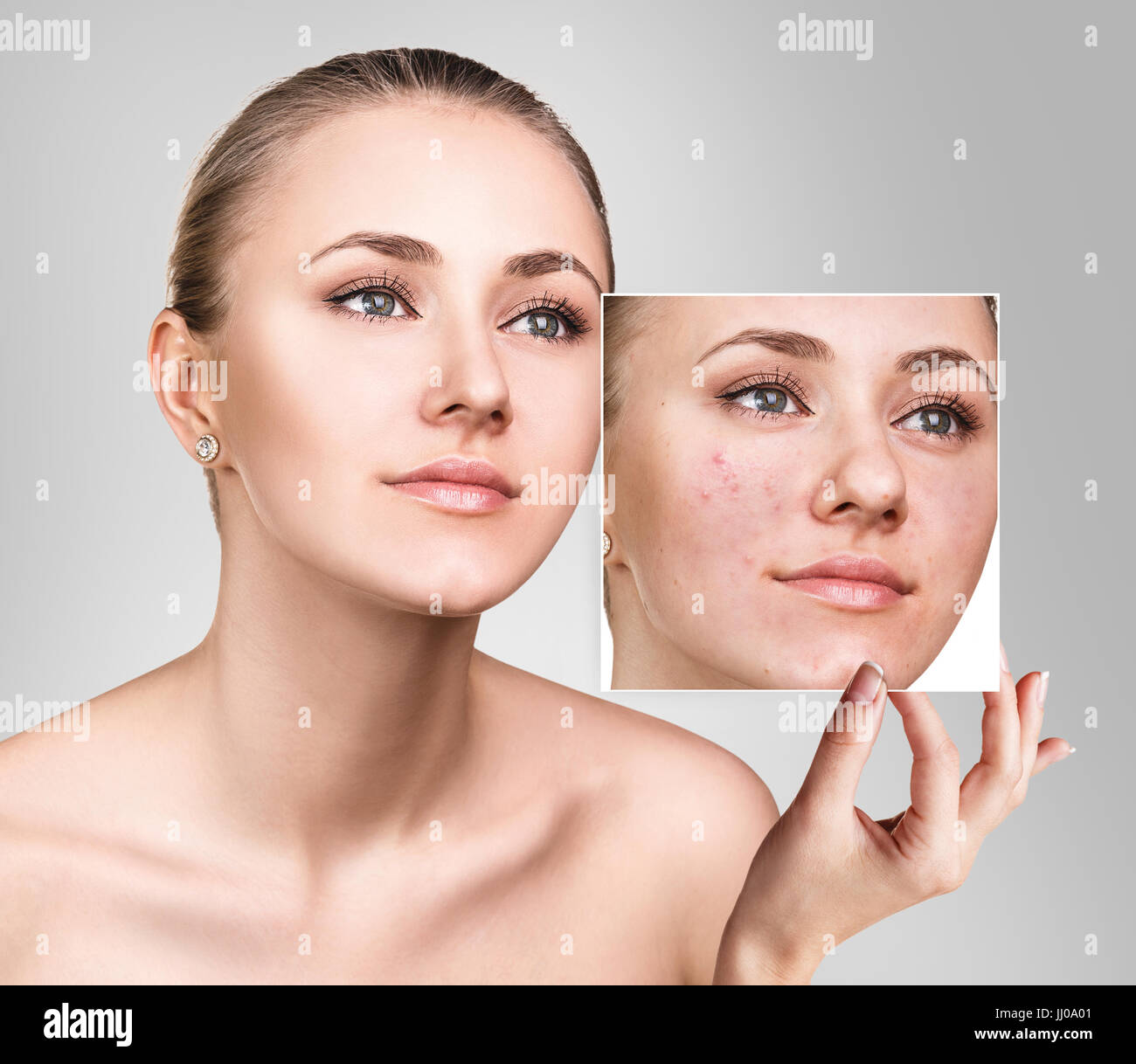 Woman shows photo with bad skin before treatment Stock Photo - Alamy