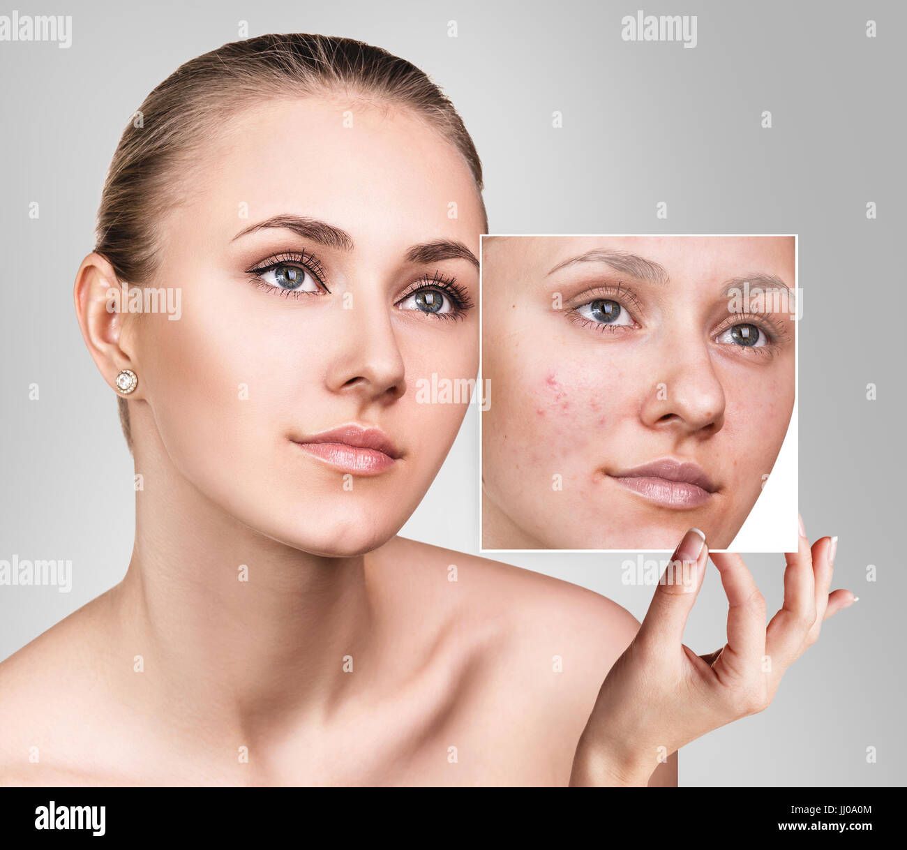 Woman shows photo with bad skin before treatment Stock Photo - Alamy
