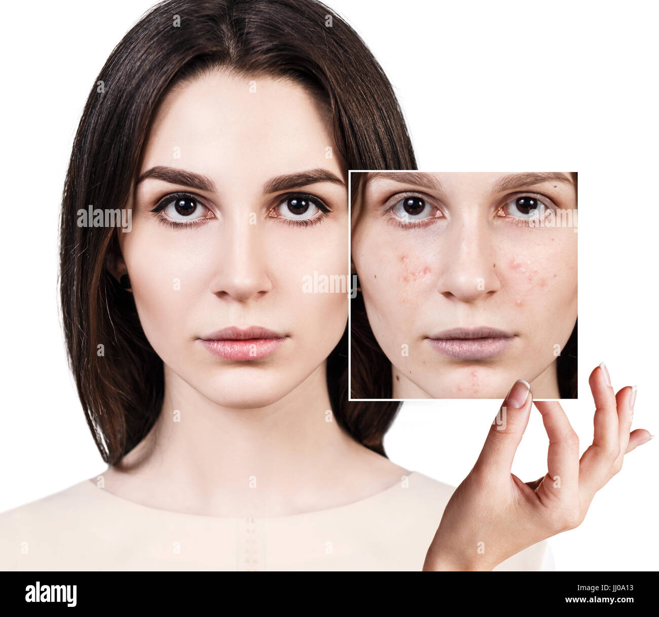 Woman shows photo with bad skin before treatment Stock Photo - Alamy