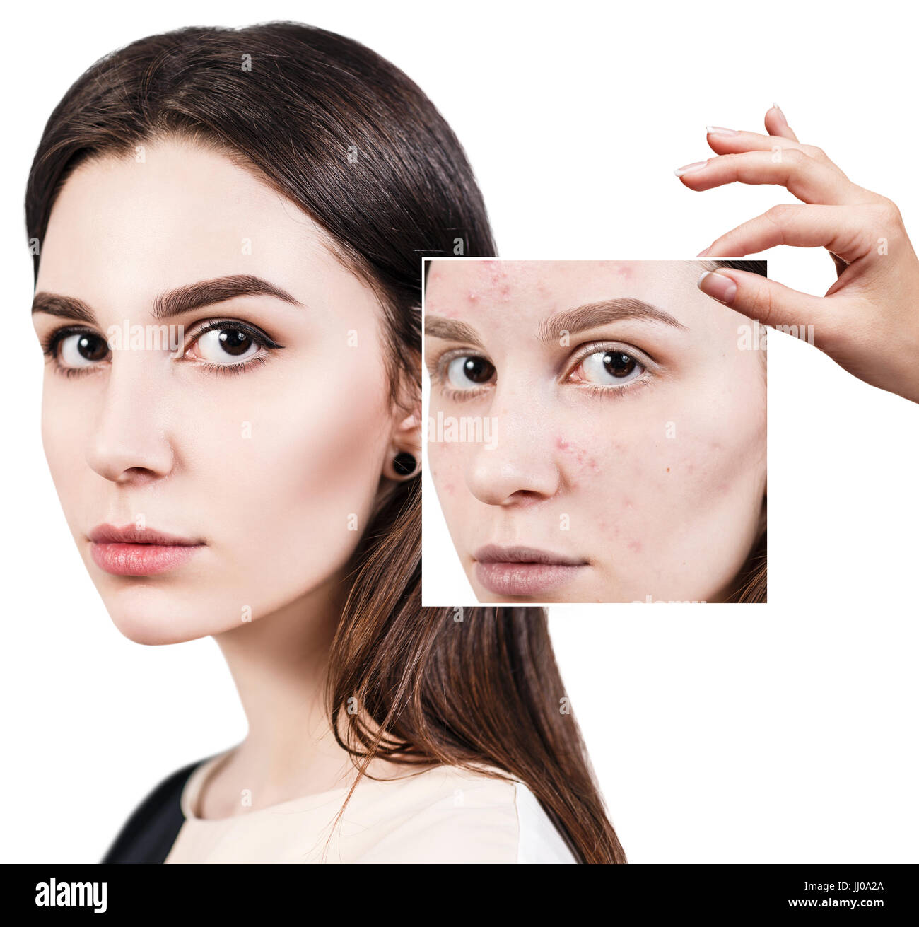 Woman shows photo with bad skin before treatment Stock Photo - Alamy