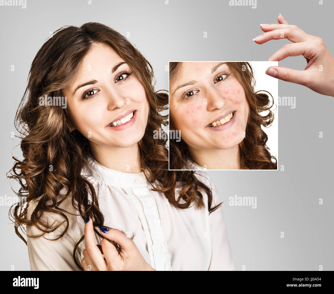 Woman shows photo with bad skin before treatment Stock Photo - Alamy