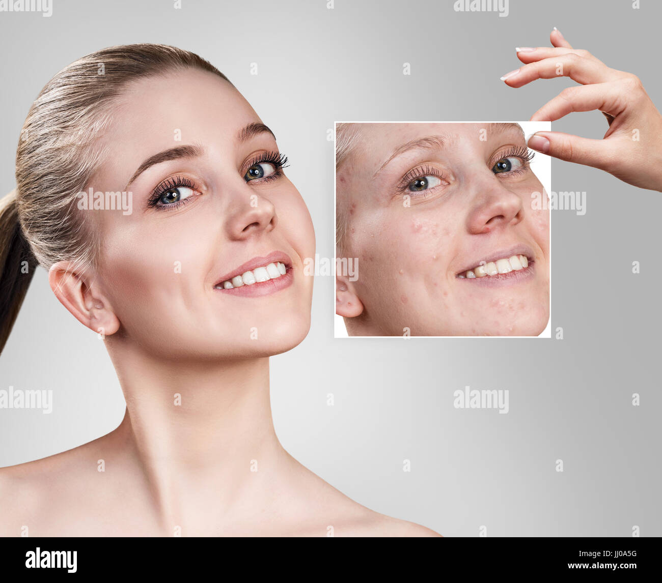 Woman shows photo with bad skin before treatment Stock Photo - Alamy