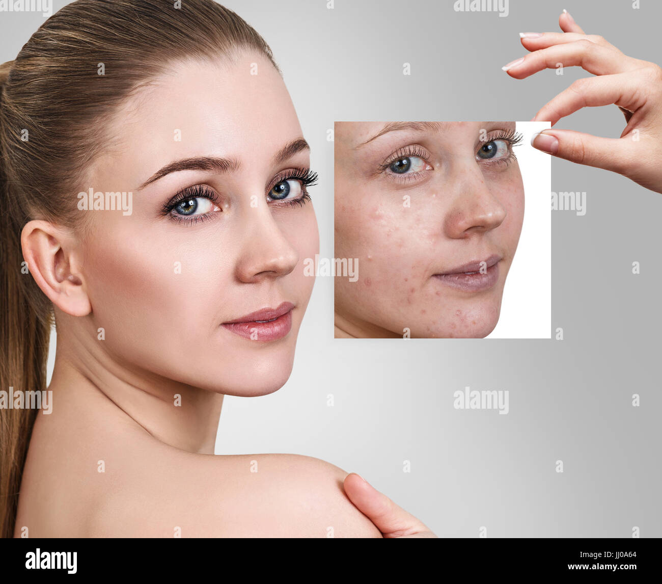 Woman shows photo with bad skin before treatment Stock Photo - Alamy