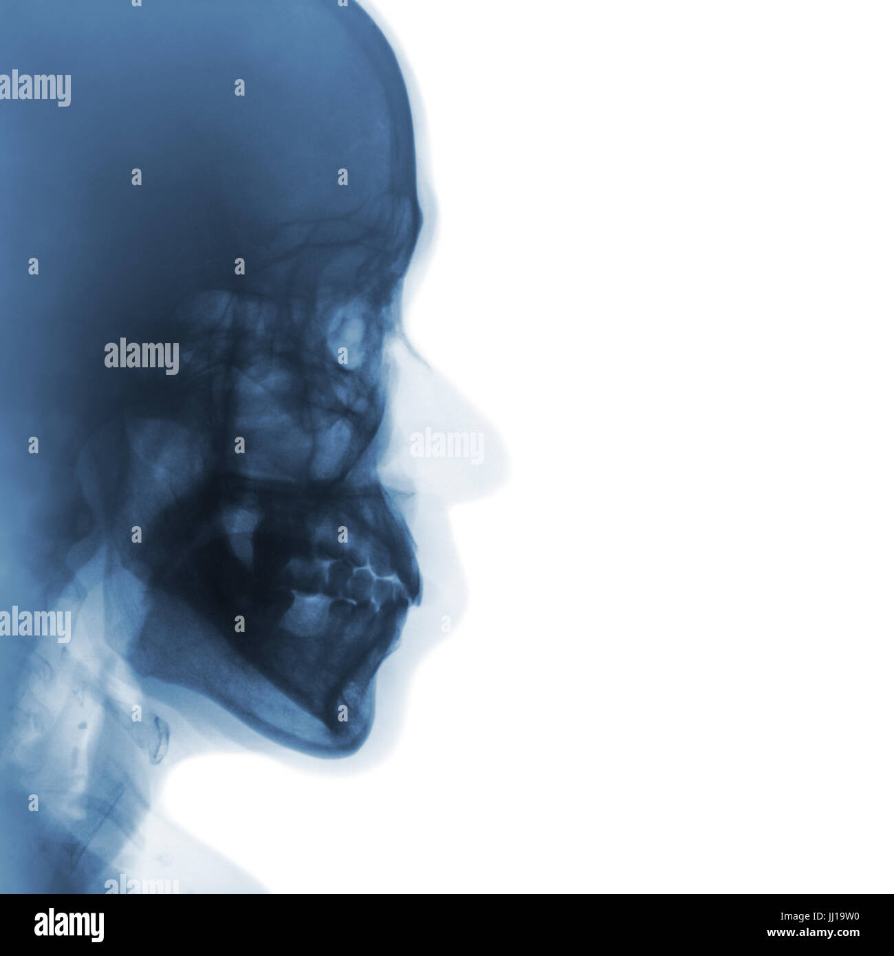 Film x-ray of normal human skull . lateral view . blank area at right ...