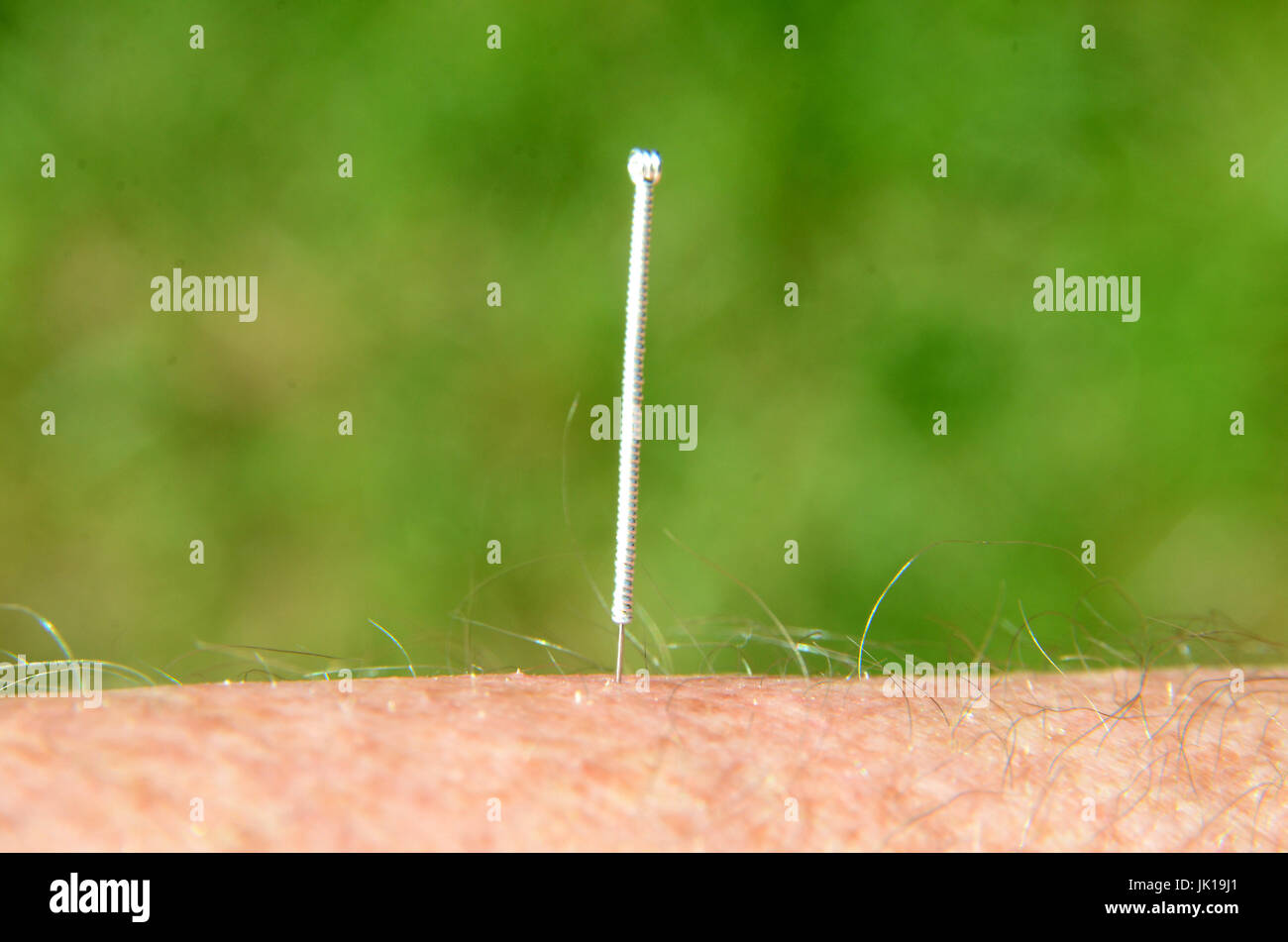 Human arm with acupuncture needle Stock Photo - Alamy