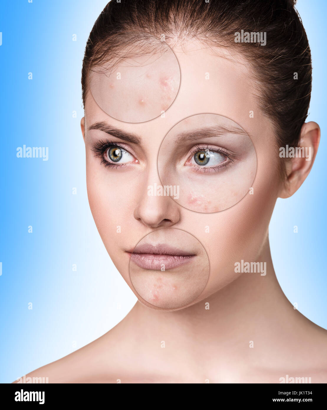 Teen skin problem hi-res stock photography and images - Alamy
