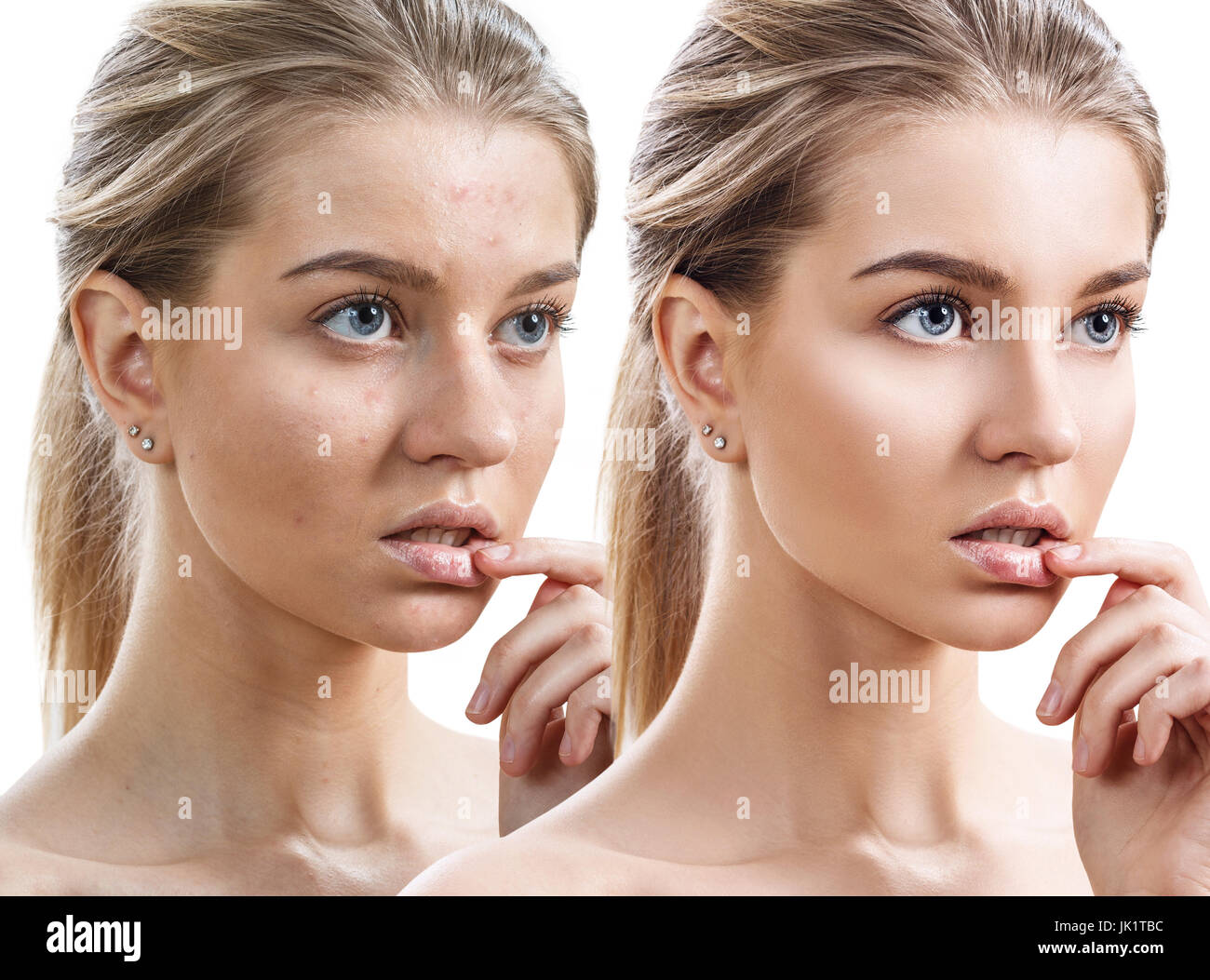 Girl with acne before and after treatment Stock Photo - Alamy