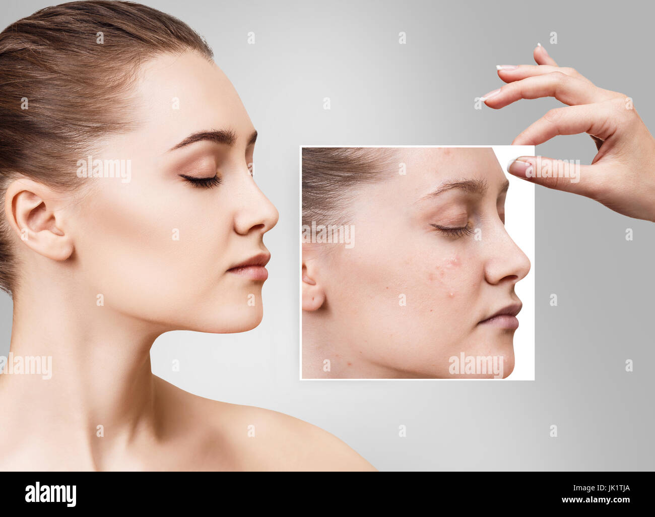 Woman shows photo with bad skin before treatment Stock Photo - Alamy
