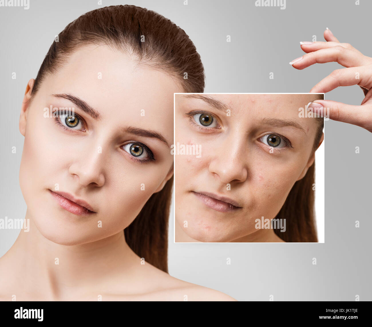 Woman shows photo with bad skin before treatment Stock Photo - Alamy
