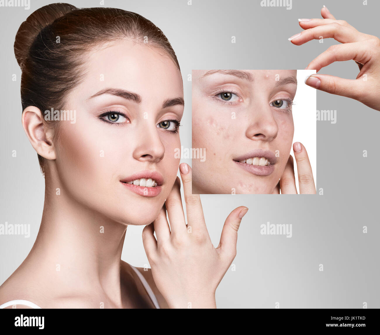 Woman shows photo with bad skin before treatment Stock Photo - Alamy