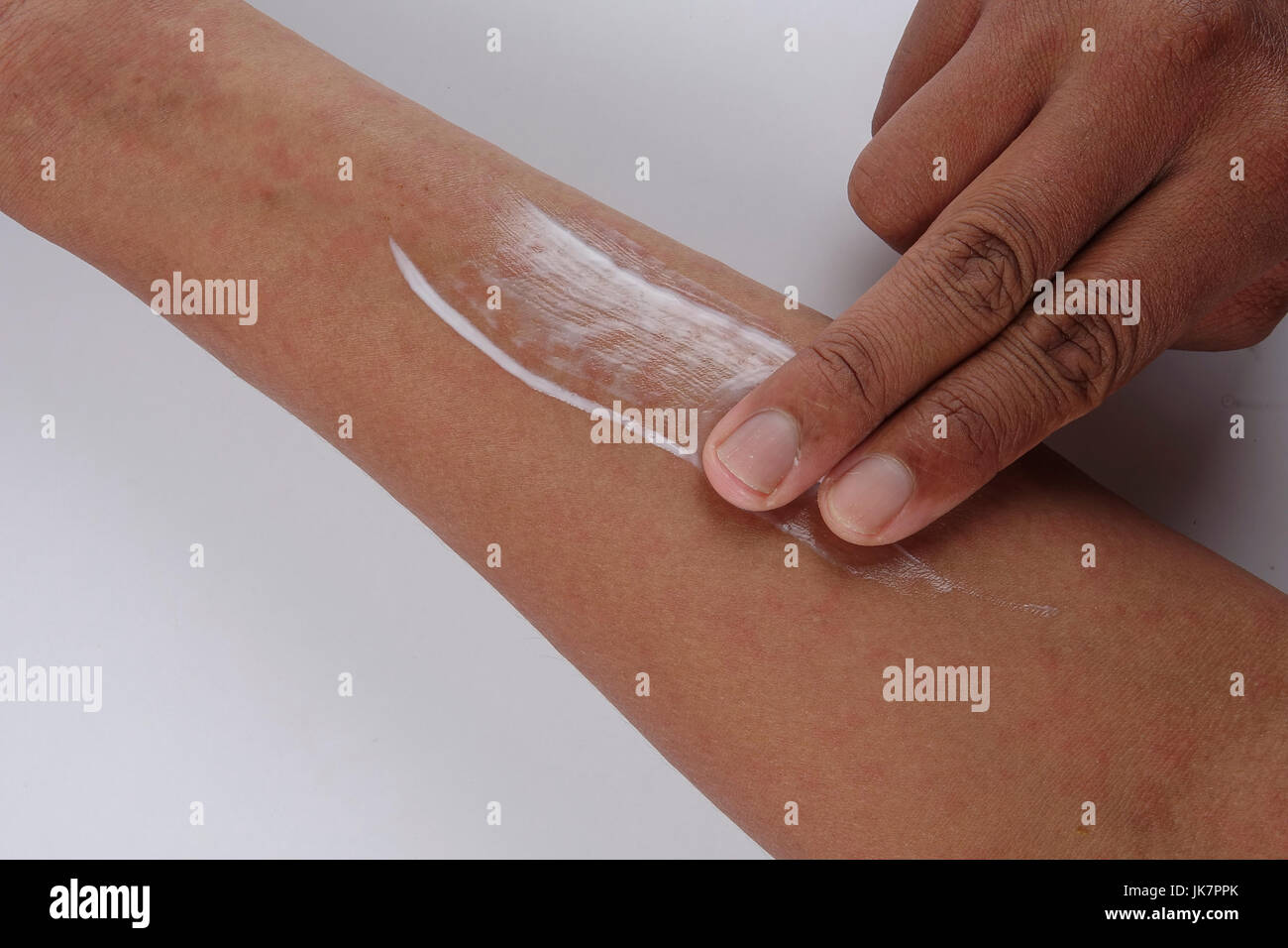 Man with dermatitis problem of rash ,Allergy rash Stock Photo - Alamy