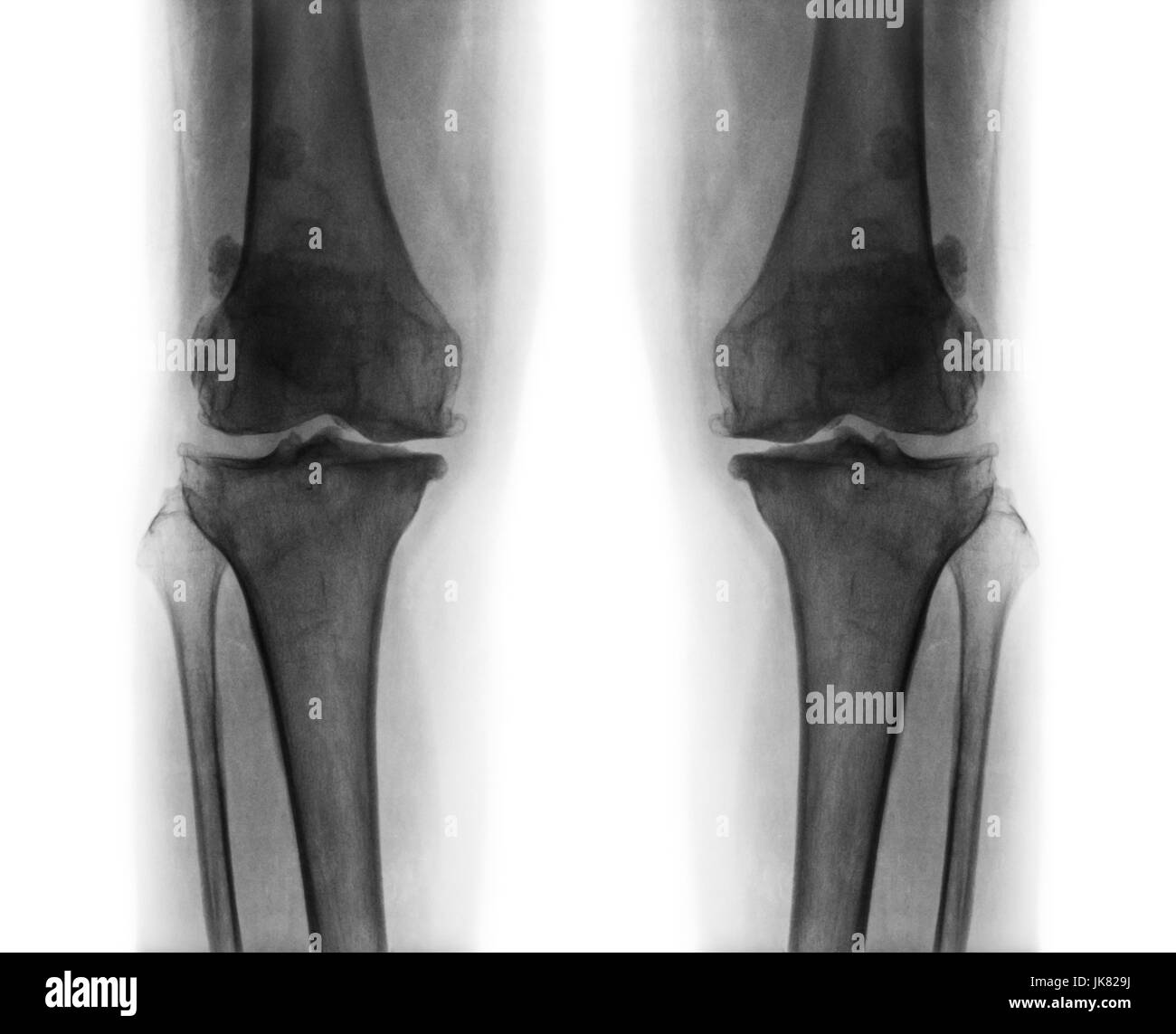 Osteoarthritis both knee . film x-ray AP ( anterior - posterior ) of ...