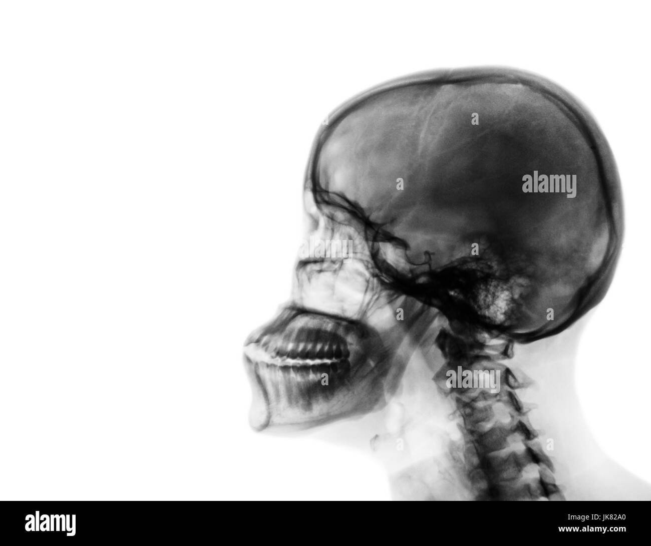 X-ray normal skull and cervical spine . Lateral view . blank area at ...