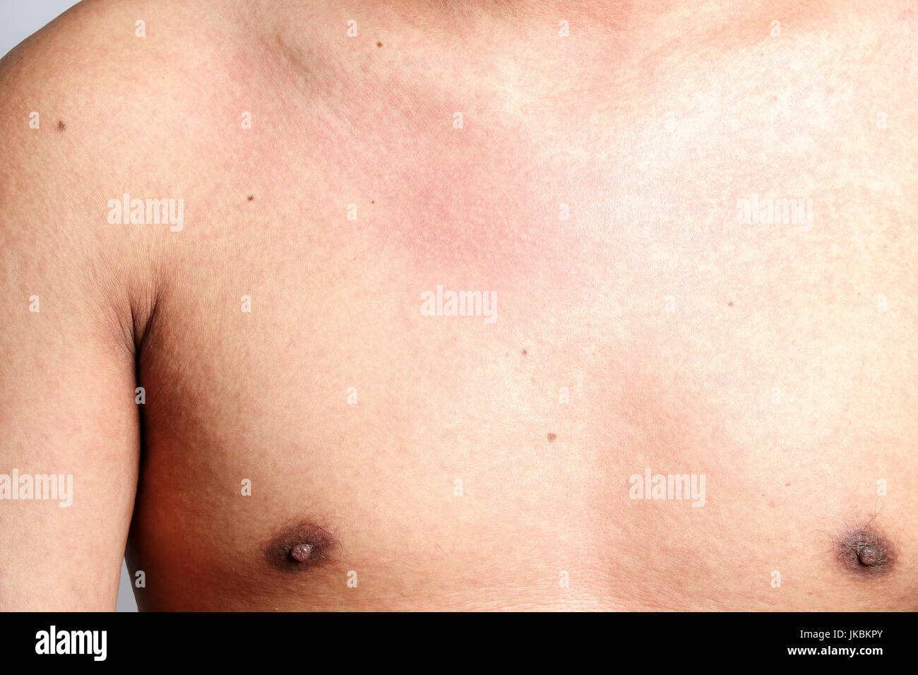 Man with dermatitis problem of rash ,Allergy rash Stock Photo - Alamy