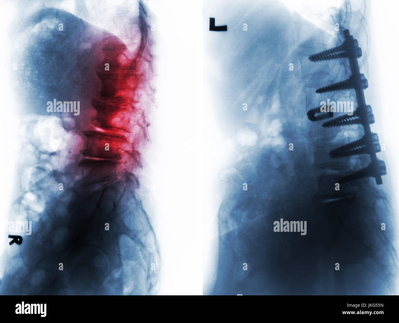 Spondylosis . Film x-ray of lumbar spine and comparison between before ...