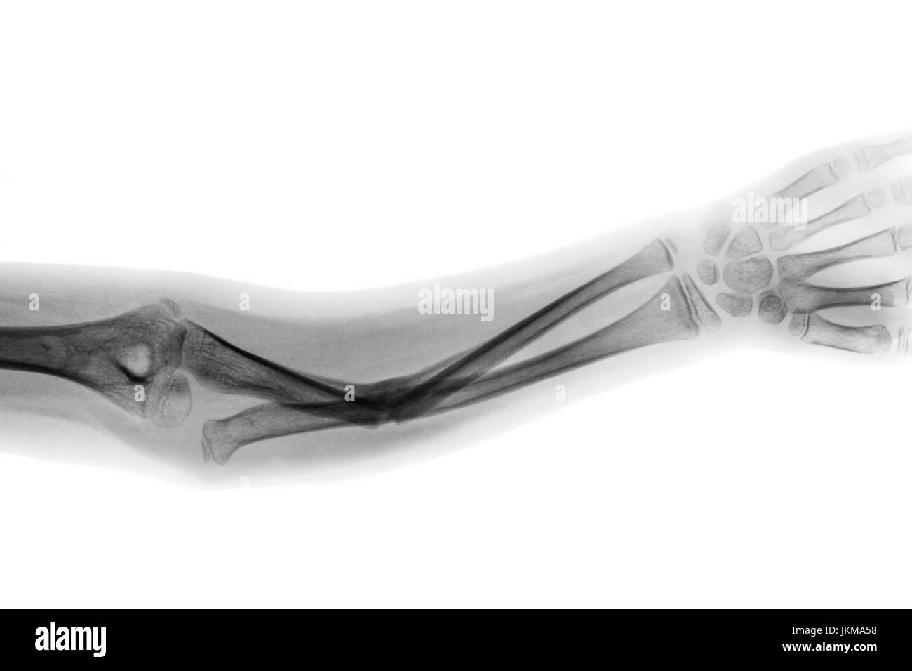 Deformed limb Black and White Stock Photos & Images - Alamy