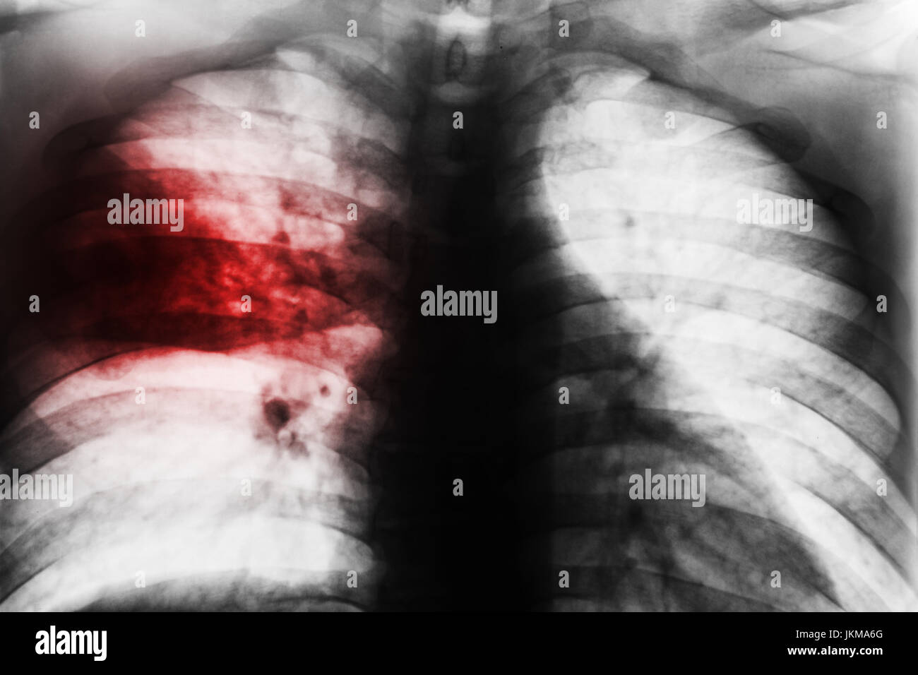 Lobar Pneumonia . Film chest x-ray show patchy infiltrate at right ...