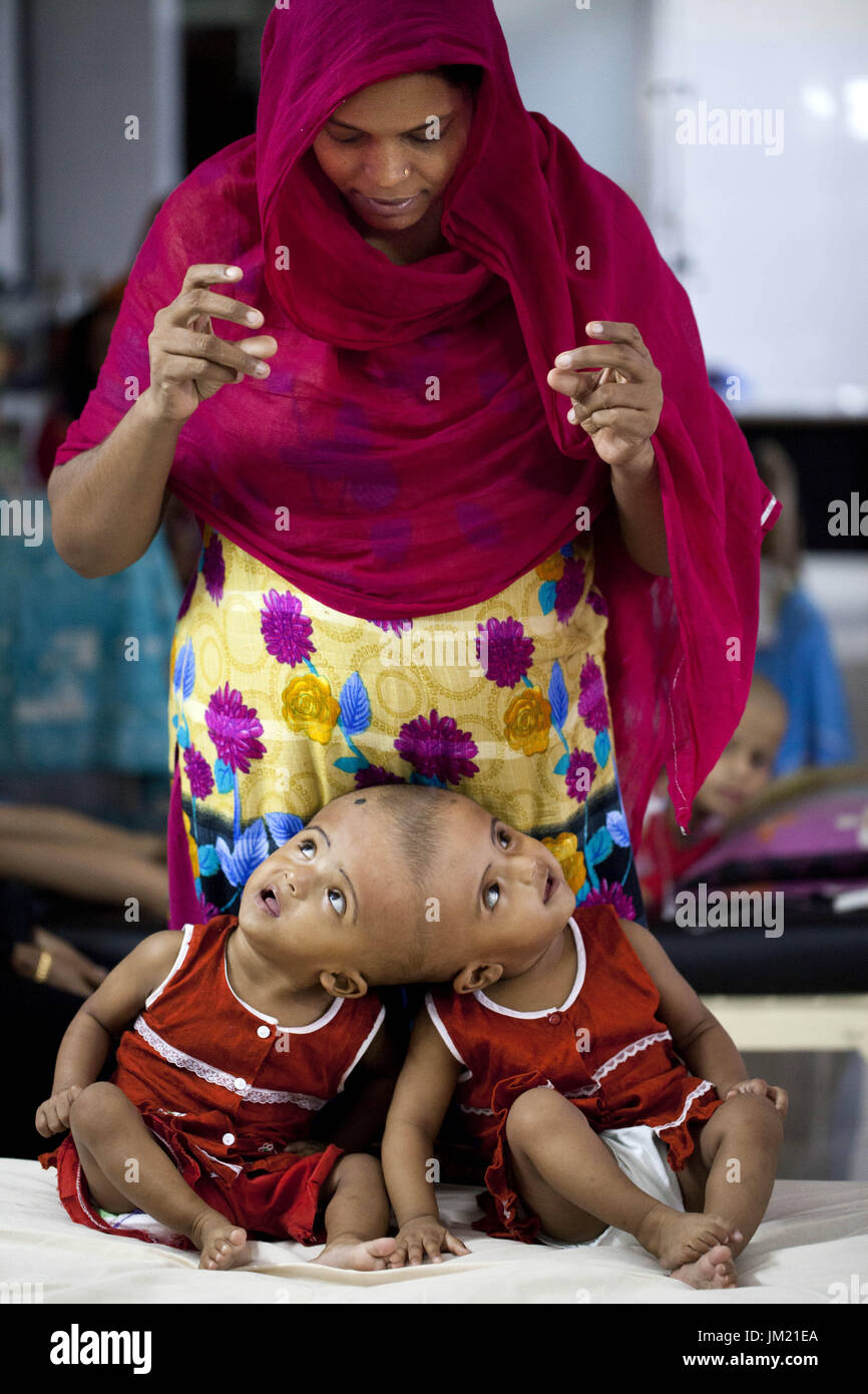 Conjoined twins baby hi-res stock photography and images - Alamy