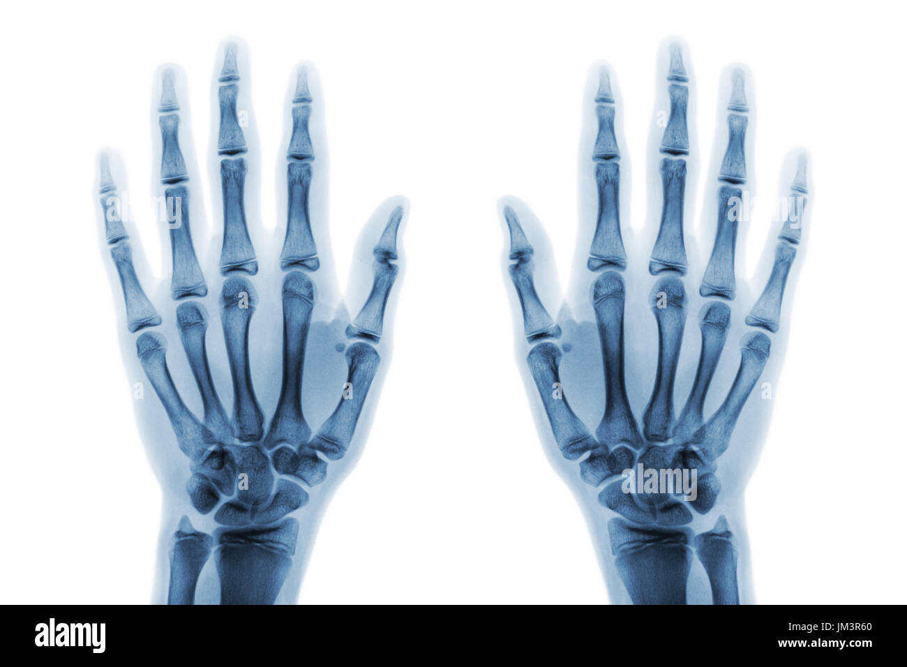 Film x-ray both hand AP show normal human hands on white background ...