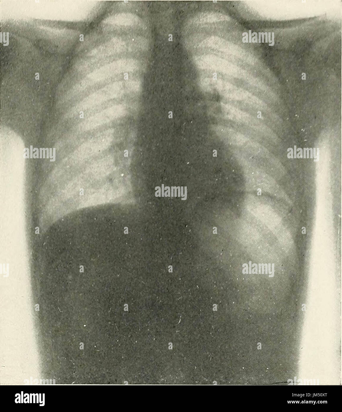 "Radio-diagnosis of pleuro-pulmonary affection" (1918) "The lobster ...