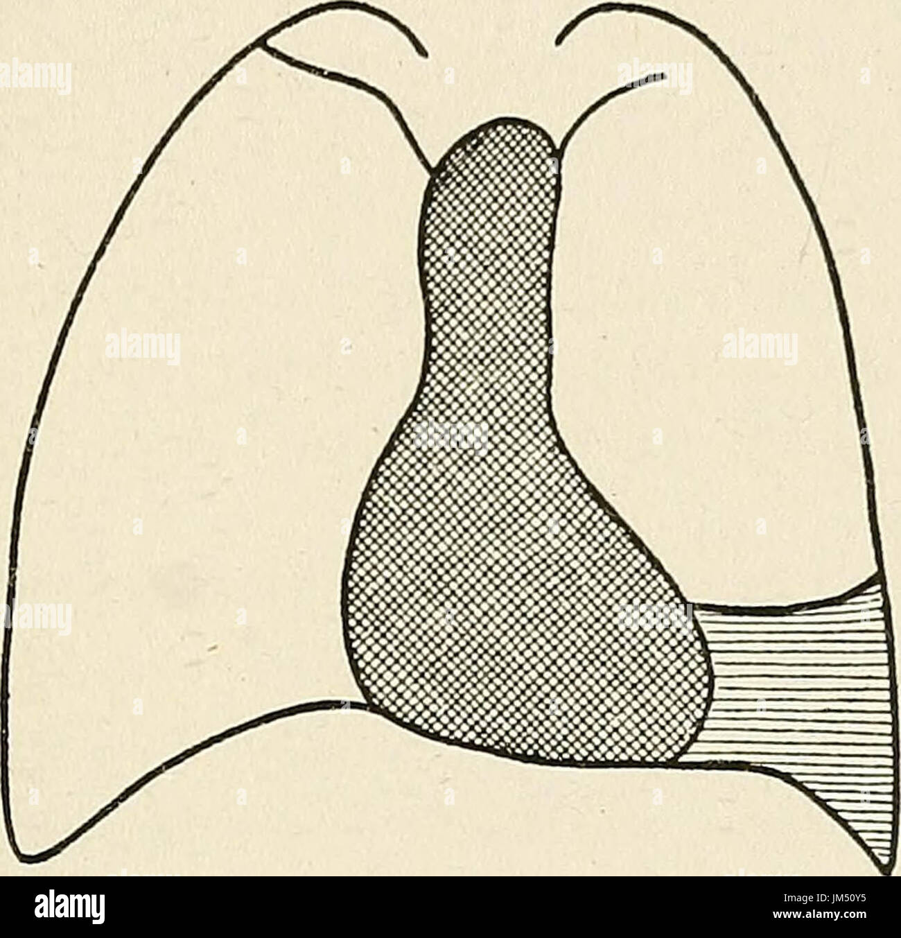 "Radio-diagnosis of pleuro-pulmonary affection" (1918) "The lobster ...