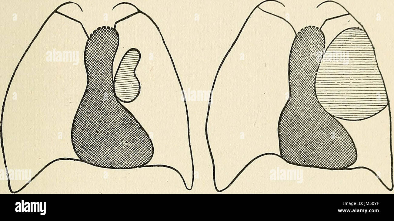 "Radio-diagnosis of pleuro-pulmonary affection" (1918) "The lobster ...