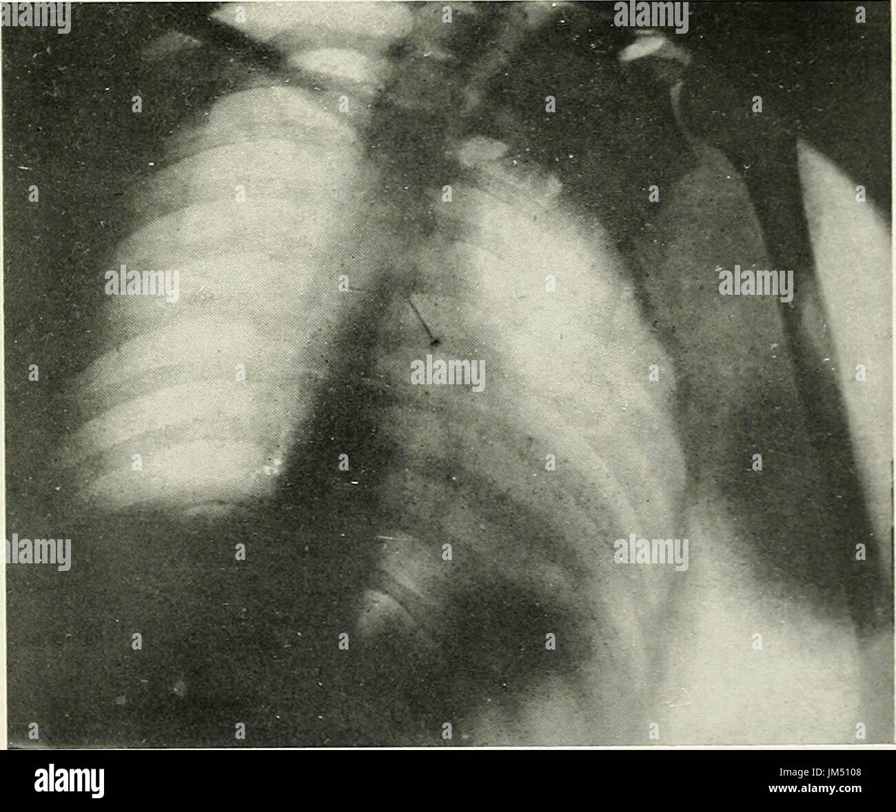 "Radio-diagnosis of pleuro-pulmonary affection" (1918) "The lobster ...