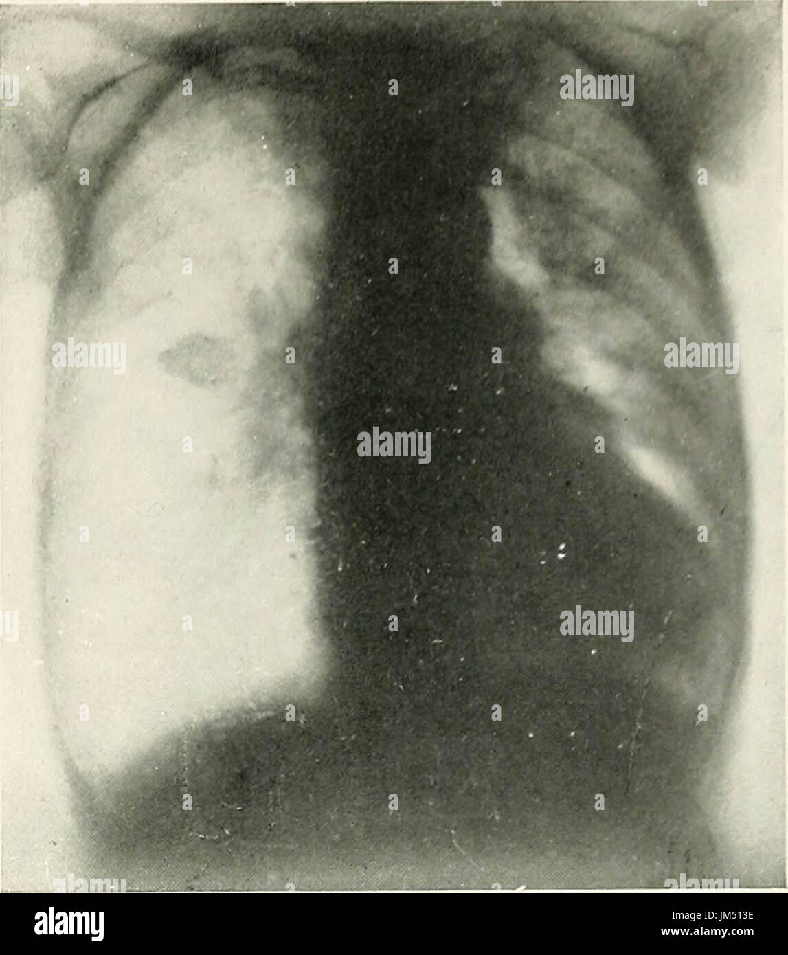 "Radio-diagnosis of pleuro-pulmonary affection" (1918 Stock Photo - Alamy