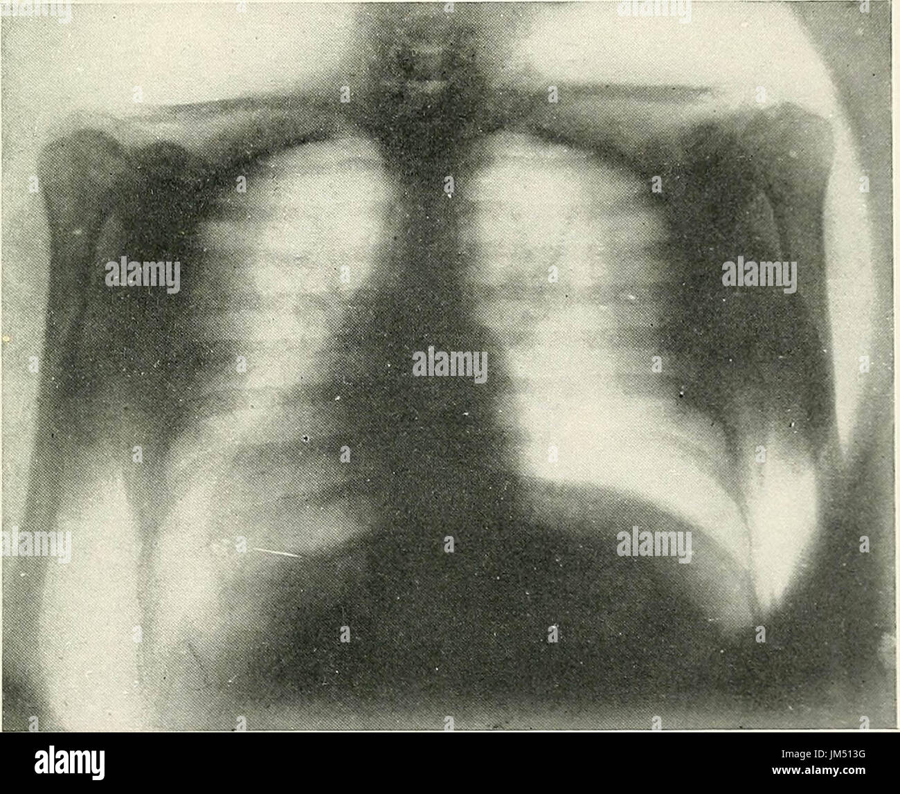 "Radio-diagnosis of pleuro-pulmonary affection" (1918 Stock Photo - Alamy