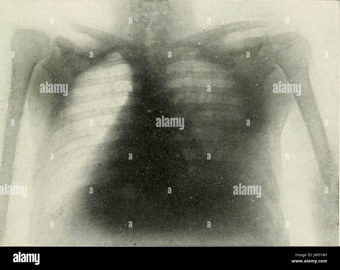 "Radio-diagnosis of pleuro-pulmonary affection" (1918 Stock Photo - Alamy