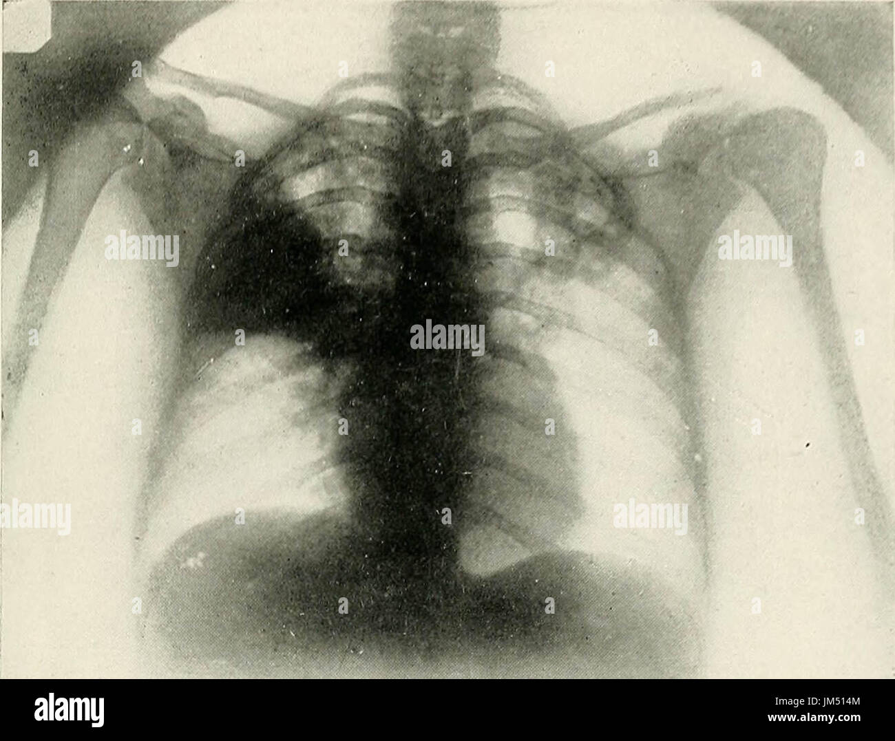 "Radio-diagnosis of pleuro-pulmonary affection" (1918 Stock Photo - Alamy
