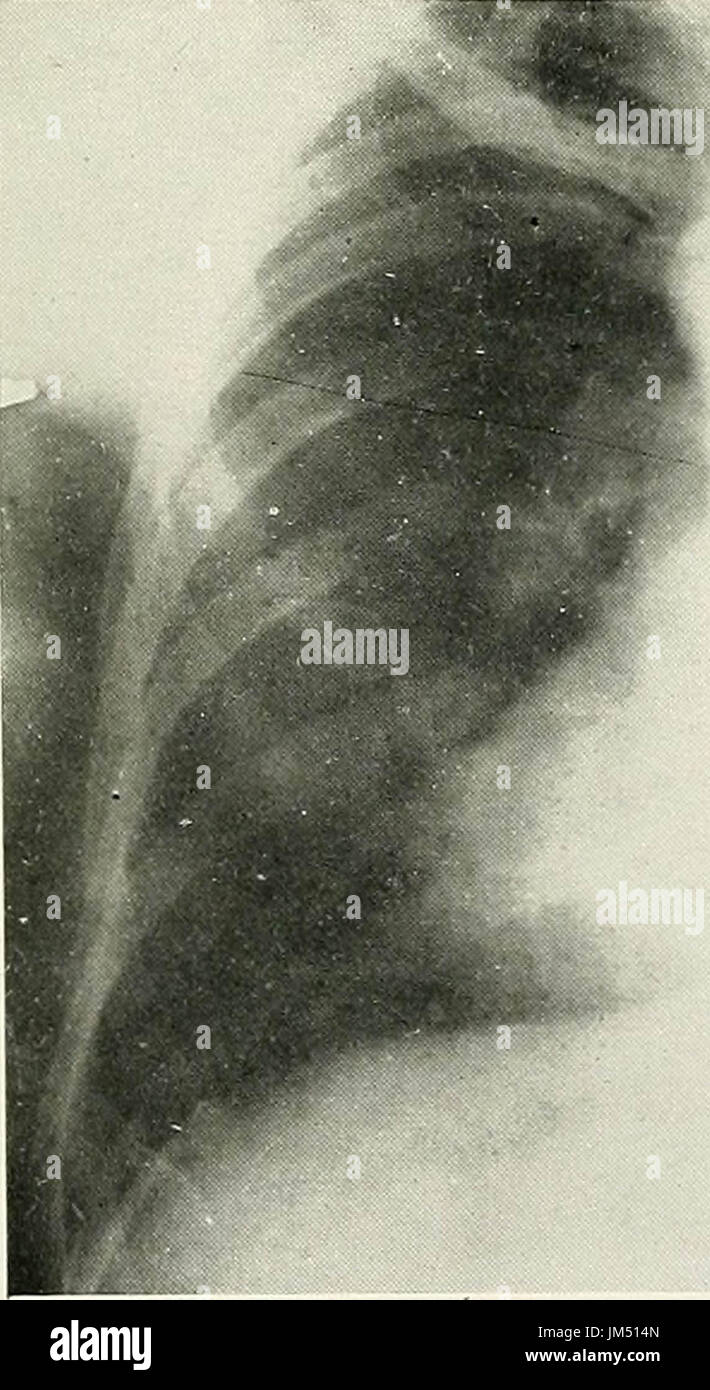"Radio-diagnosis of pleuro-pulmonary affection" (1918 Stock Photo - Alamy