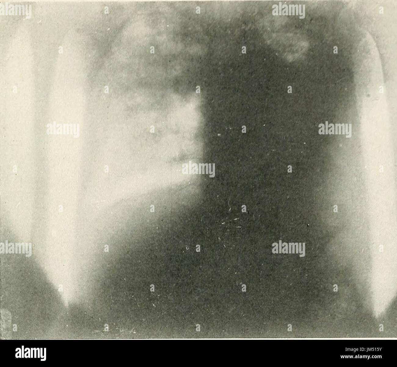 "Radio-diagnosis of pleuro-pulmonary affection" (1918 Stock Photo - Alamy