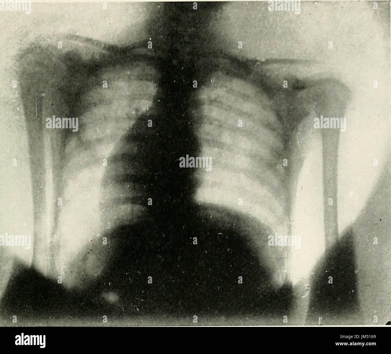 "Radio-diagnosis of pleuro-pulmonary affection" (1918 Stock Photo - Alamy