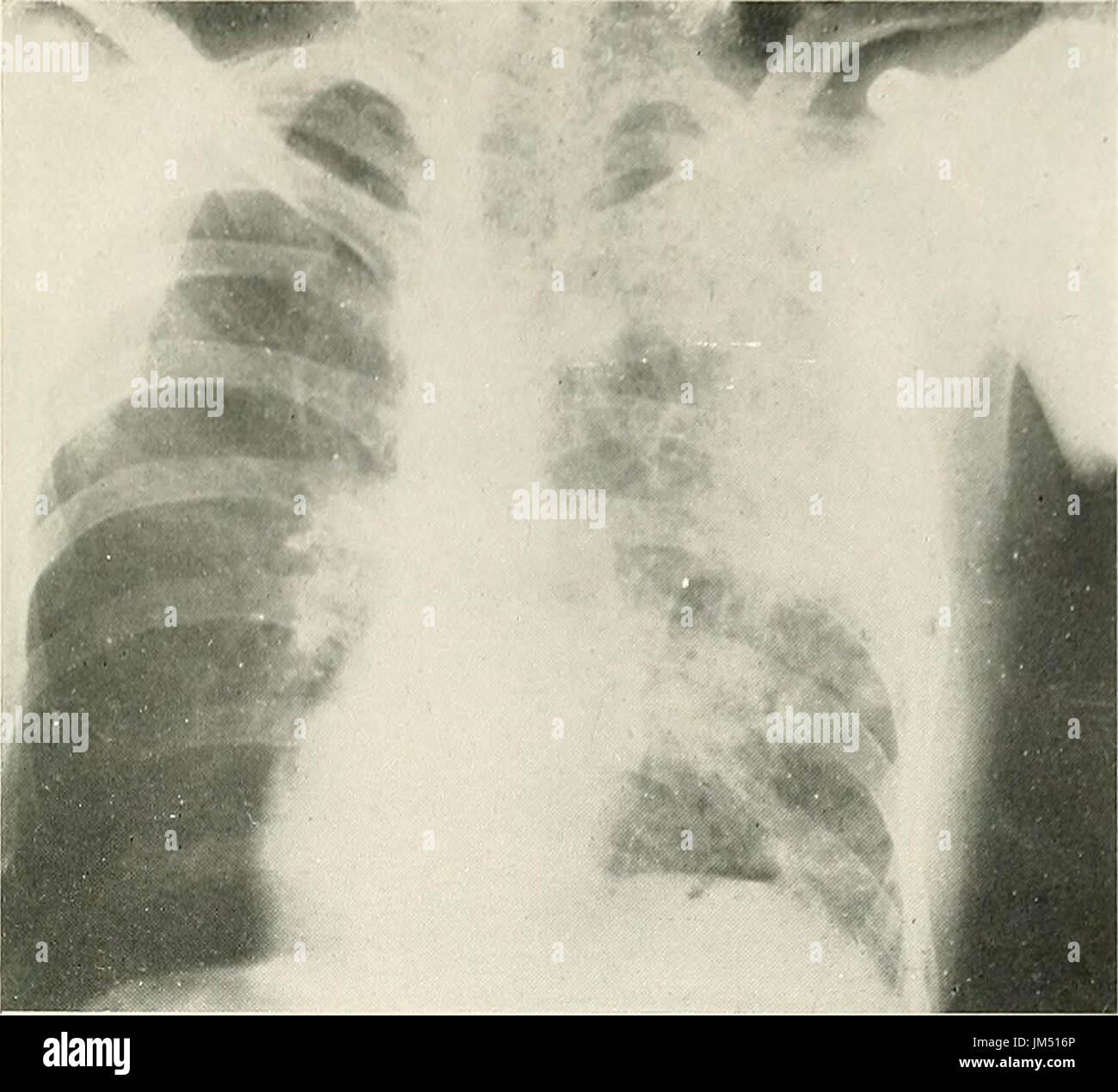 "Radio-diagnosis of pleuro-pulmonary affection" (1918 Stock Photo - Alamy