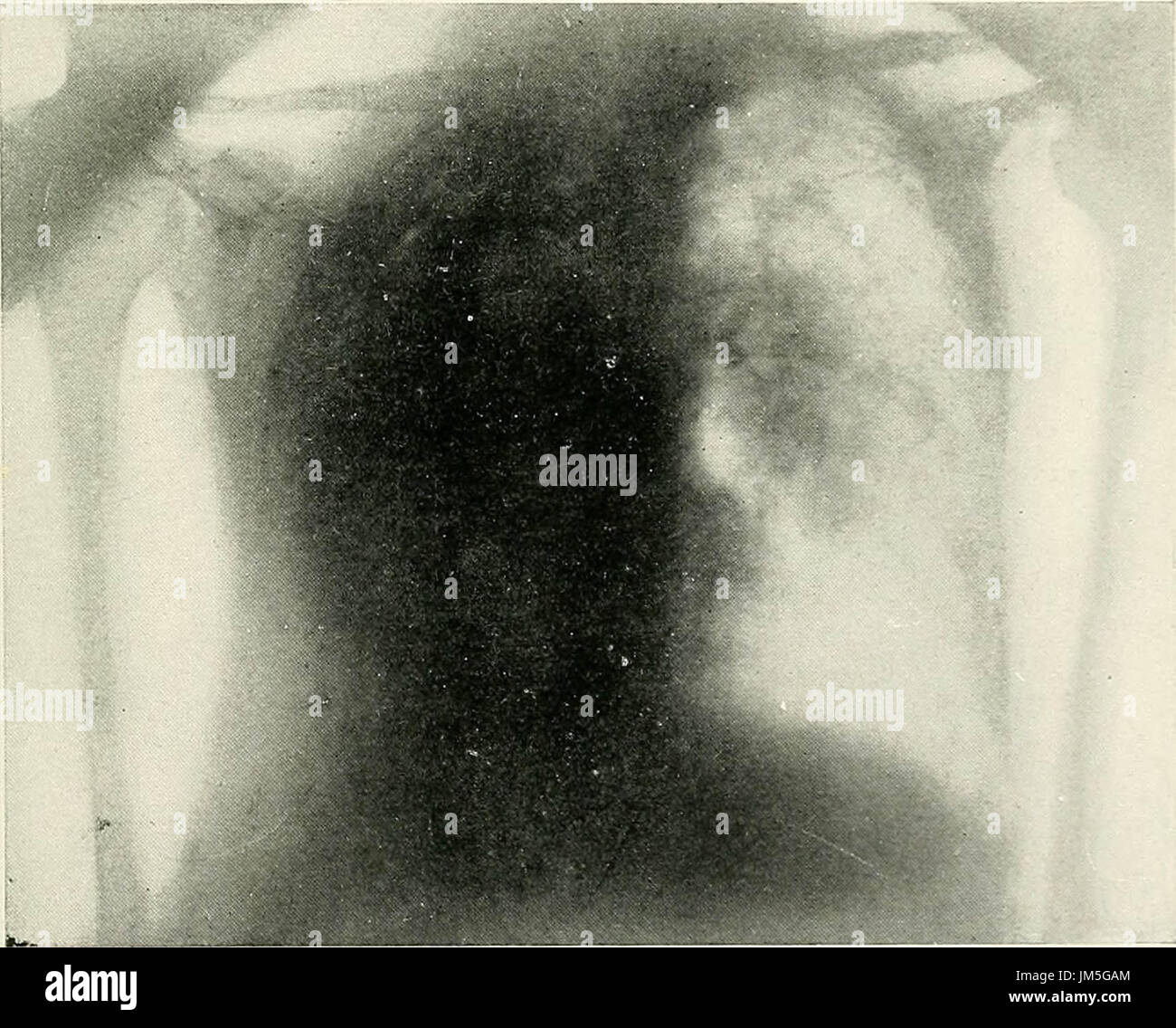 "Radio-diagnosis of pleuro-pulmonary affection" (1918 Stock Photo - Alamy