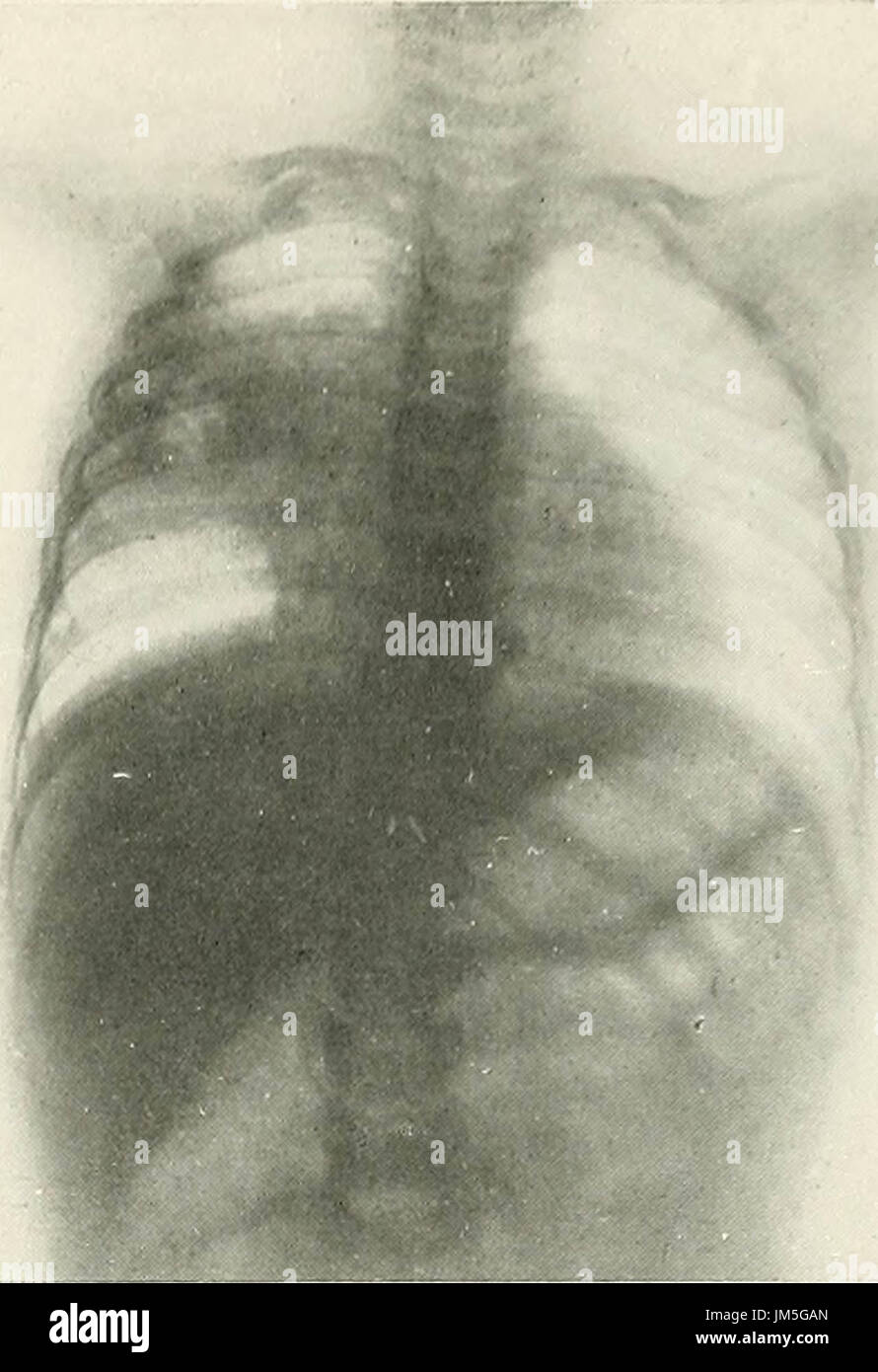 "Radio-diagnosis of pleuro-pulmonary affection" (1918 Stock Photo - Alamy