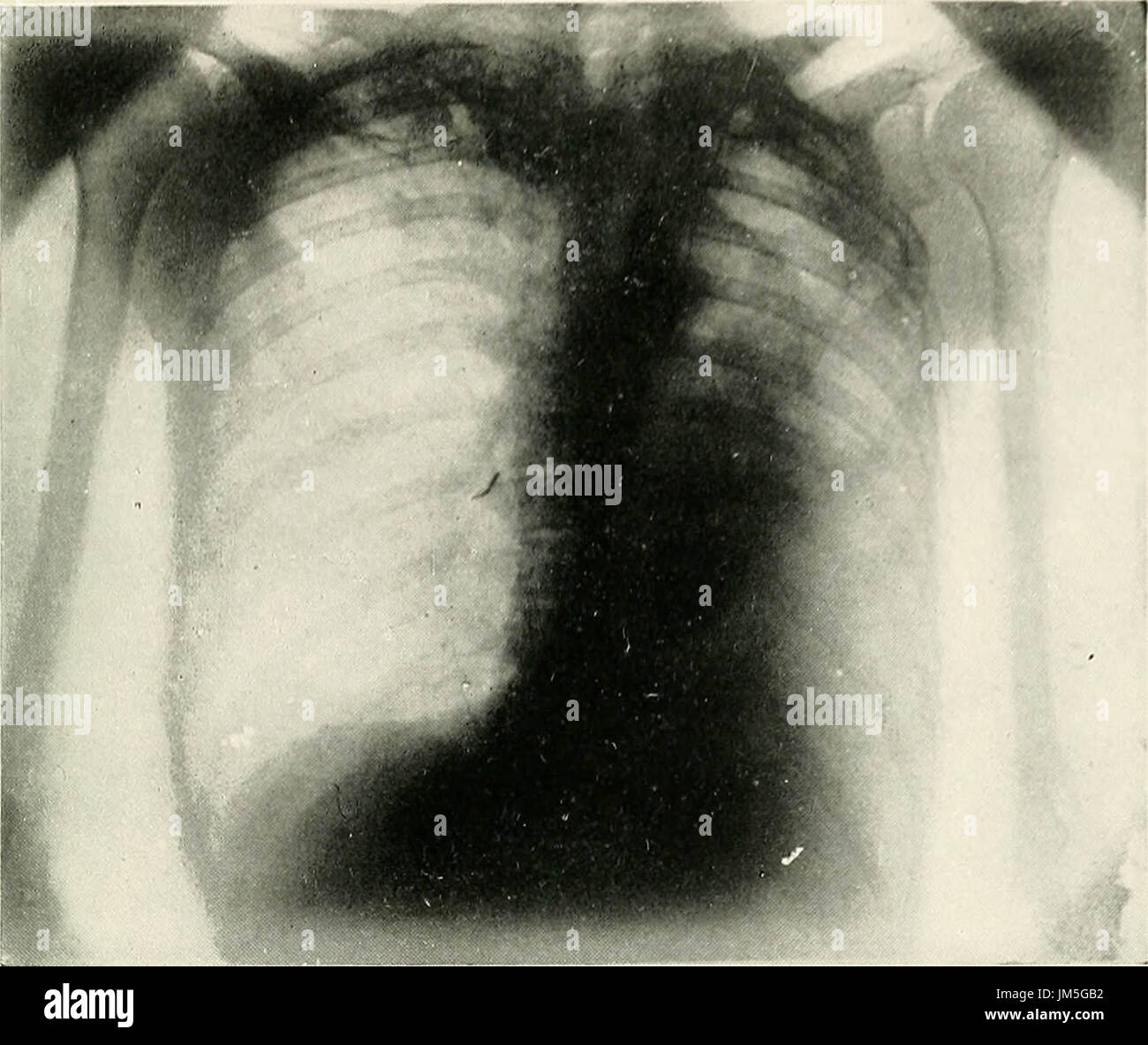 "Radio-diagnosis of pleuro-pulmonary affection" (1918 Stock Photo - Alamy