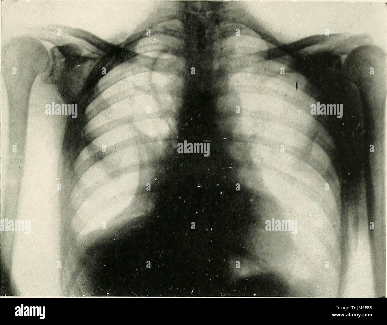 "Radio-diagnosis of pleuro-pulmonary affection" (1918 Stock Photo - Alamy