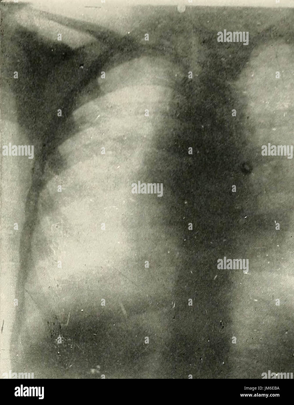 "Radio-diagnosis of pleuro-pulmonary affection" (1918 Stock Photo - Alamy