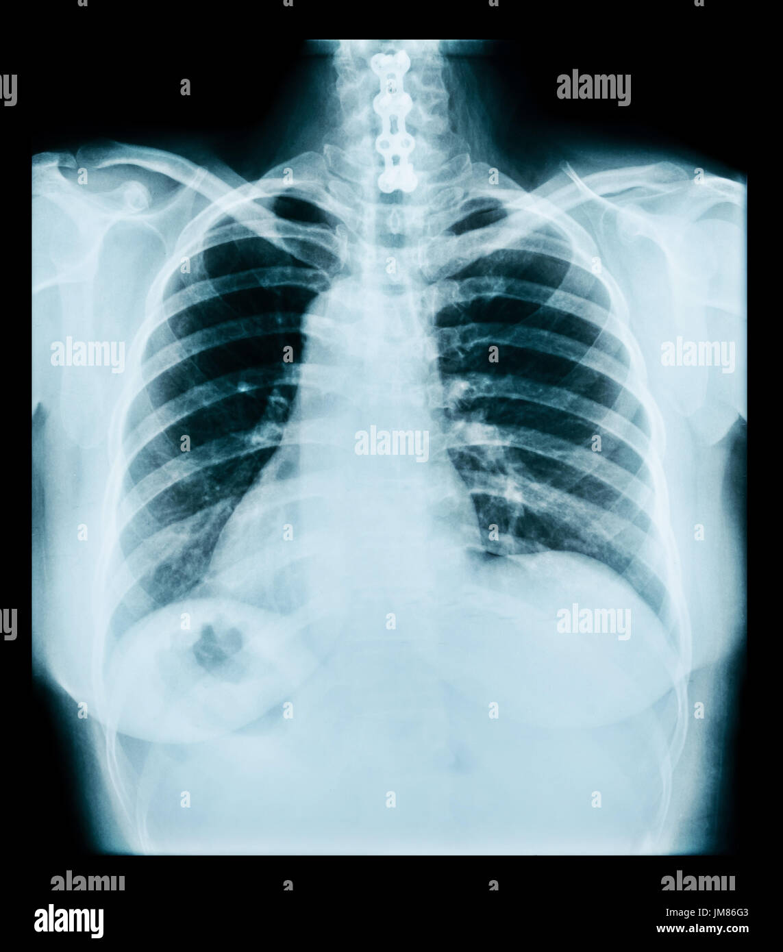 medical radiograph of thorax. ray, lungs, chest Stock Photo - Alamy