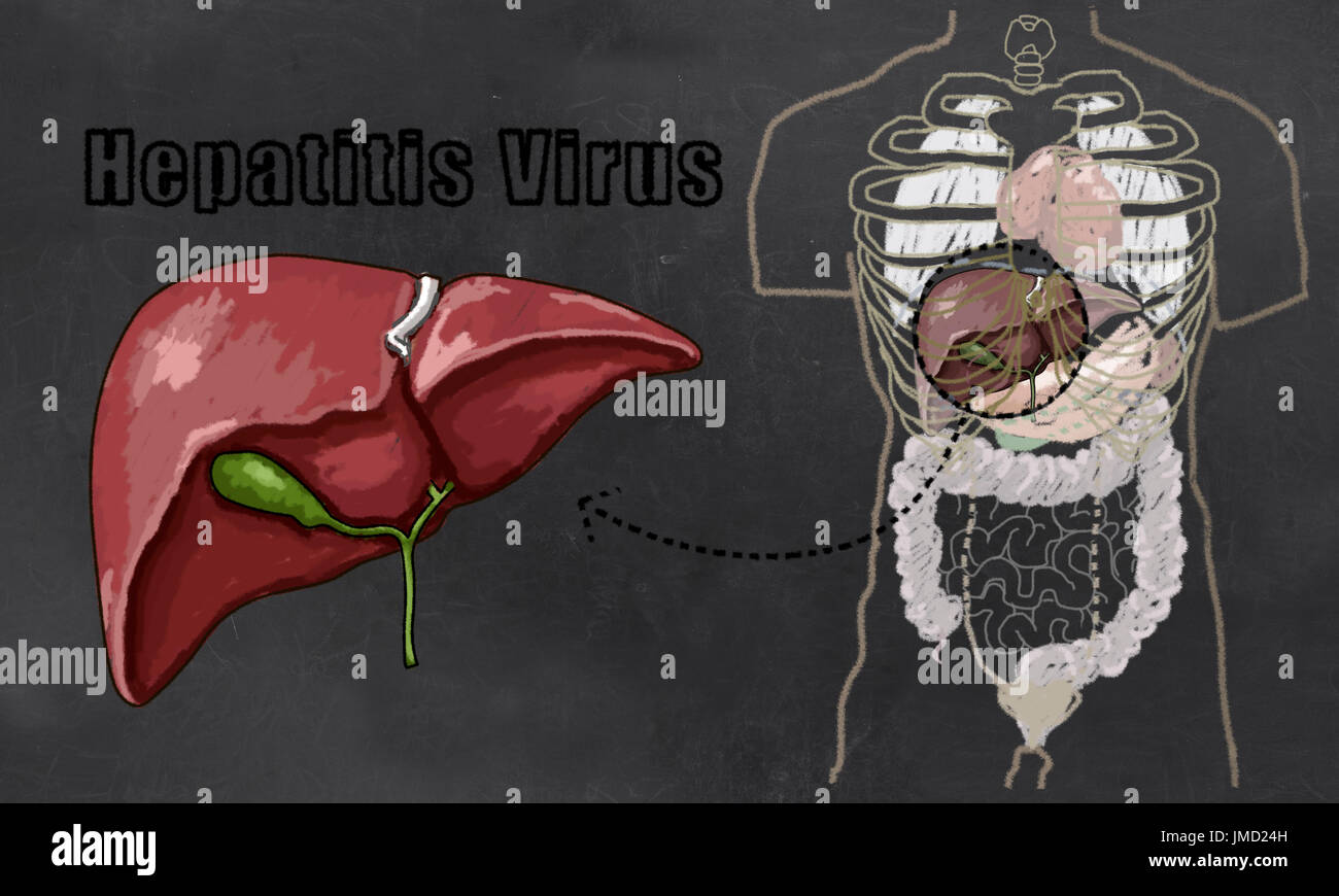 Hepatitis Liver Illustration Stock Photo - Alamy