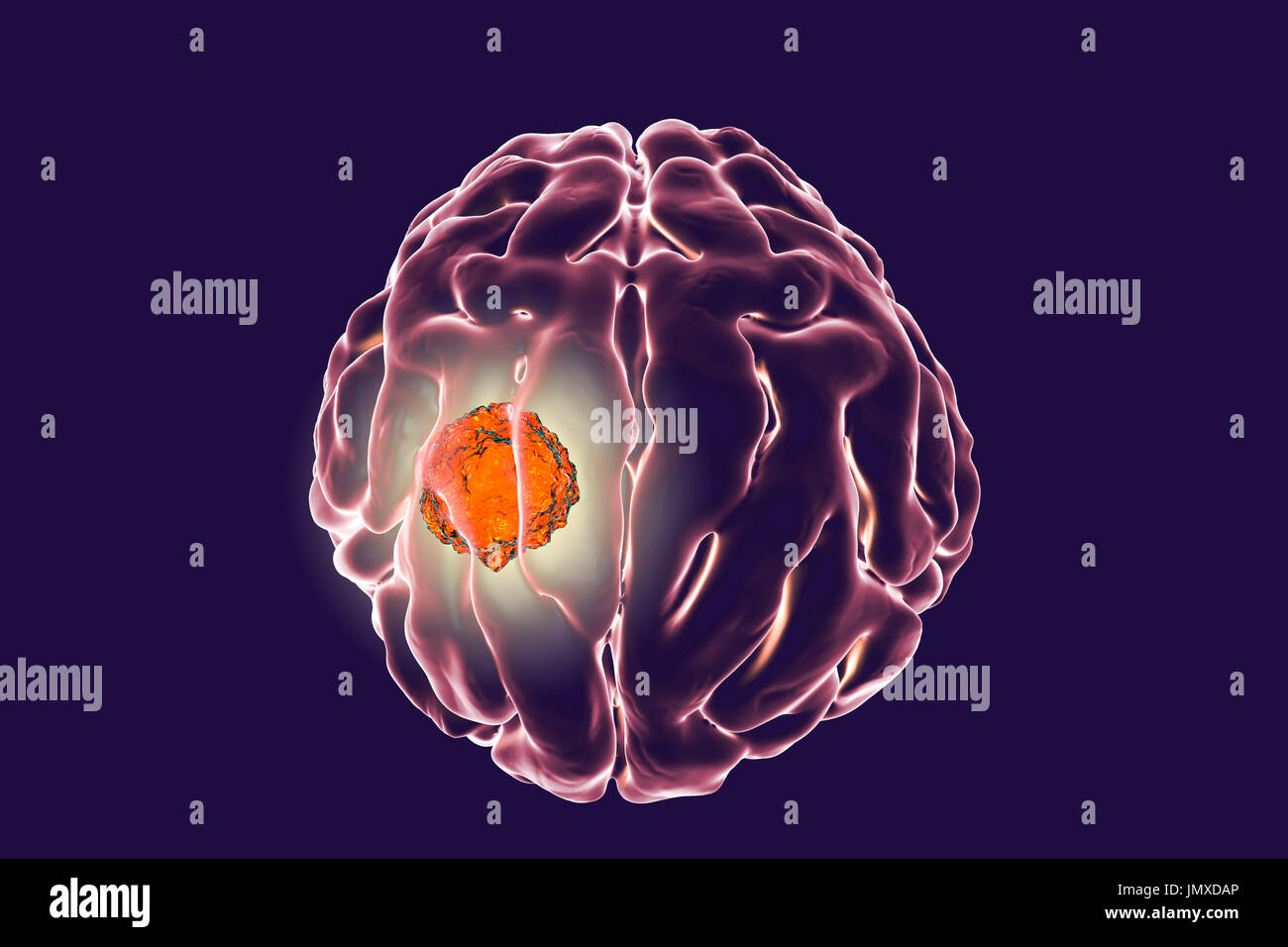 Brain cancer hi-res stock photography and images - Alamy