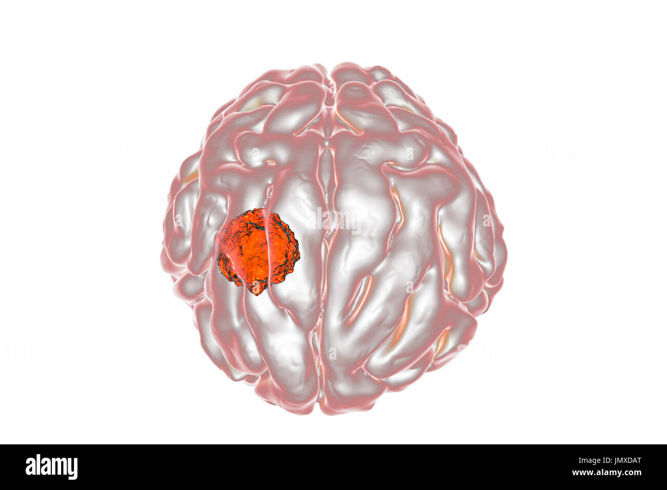 Brain cancer hi-res stock photography and images - Alamy