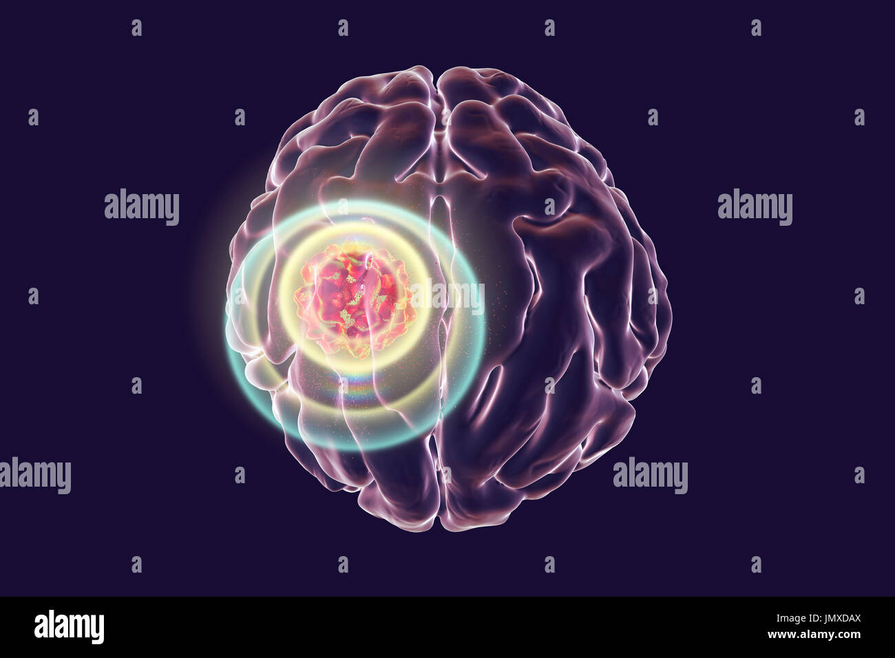 Conceptual image for brain cancer treatment. Computer illustration ...