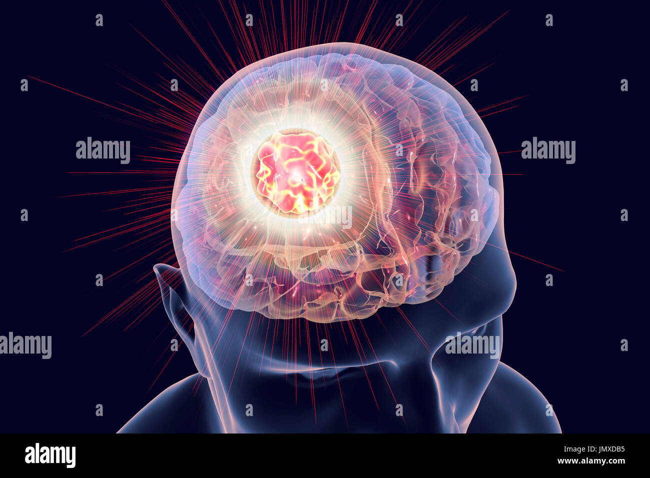 Conceptual image for brain cancer treatment. Computer illustration ... Conceptual image for brain cancer treatment. Computer illustration ...