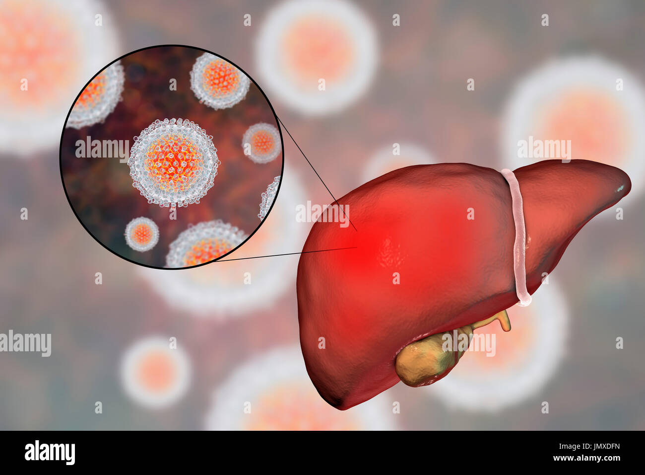 Liver with hepatitis and close-up view of hepatitis C viruses ...