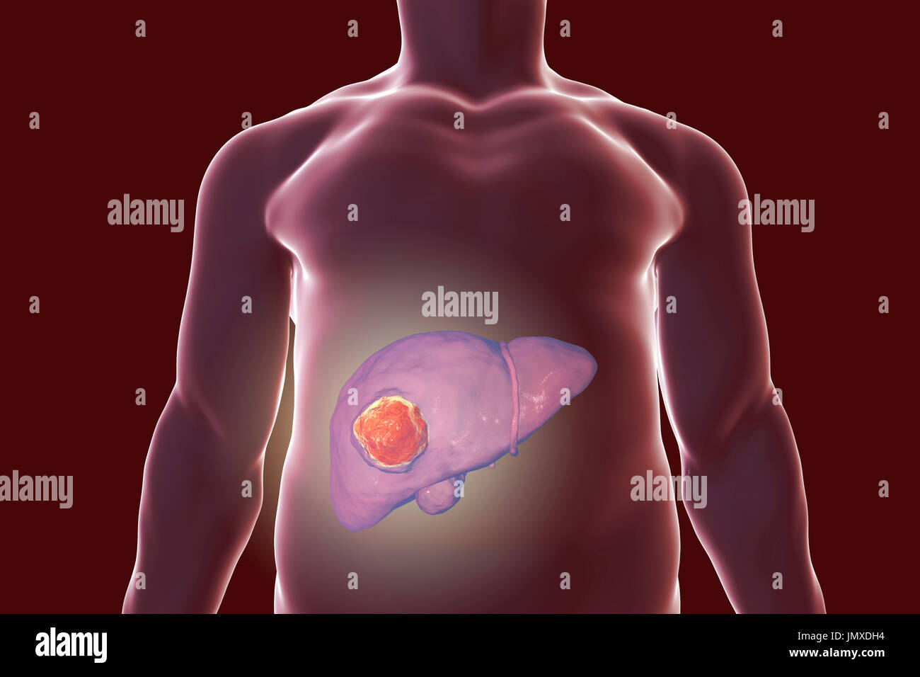 Liver cancer hi-res stock photography and images - Alamy