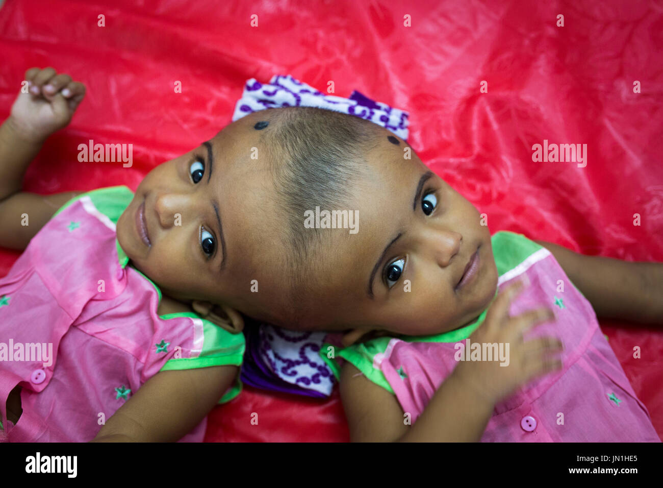 Human conjoined twins hi-res stock photography and images - Alamy